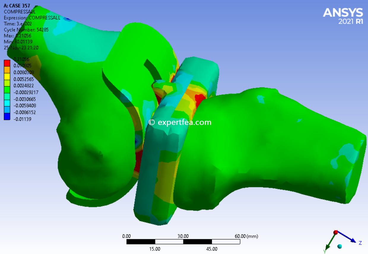 ANSYS Workbench 2021 R1 solved WBPZ archive + 3D model for knee implant