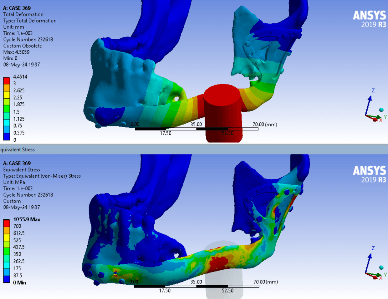 ANSYS Workbench 2019 R3 solved WBPZ archive + 3D model for mandibular fracture implant