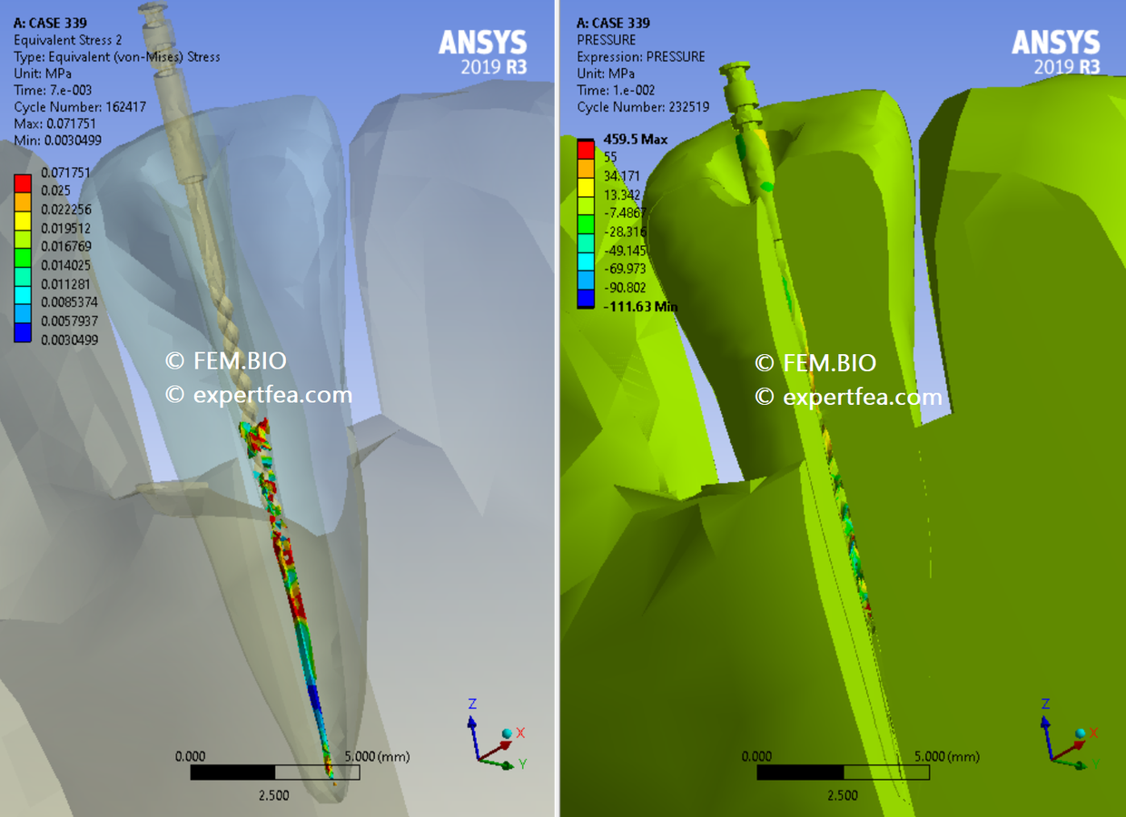ANSYS Workbench 2019 R3 WBPZ archive and 3D model for endodontics ...