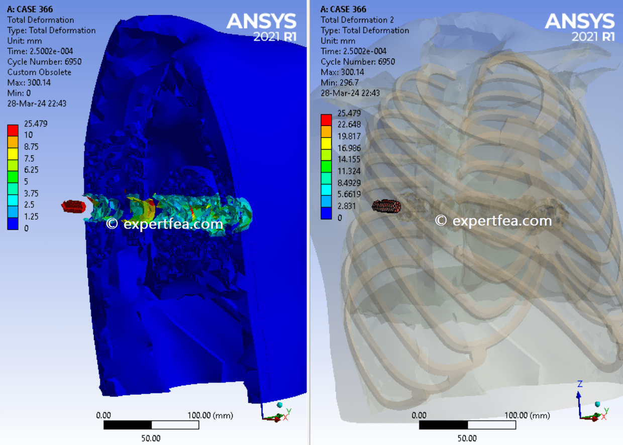 ANSYS Workbench 2021 R1 fully solved WBPZ archive with 3D model for 0.50 BMG bullet thru chest