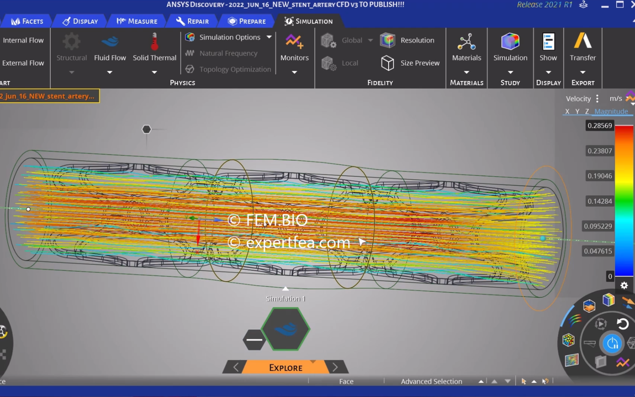 ANSYS DISCOVERY 2021 R1 solved file for Simple Hemodynamics CFD: Blood Flow Through Stented Vessel