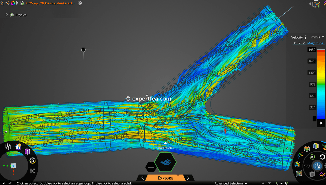 ANSYS Discovery 2022 R1 CFD with 3D model for Haeomdynamics of Kissing Stents in Aortic Bifurcation