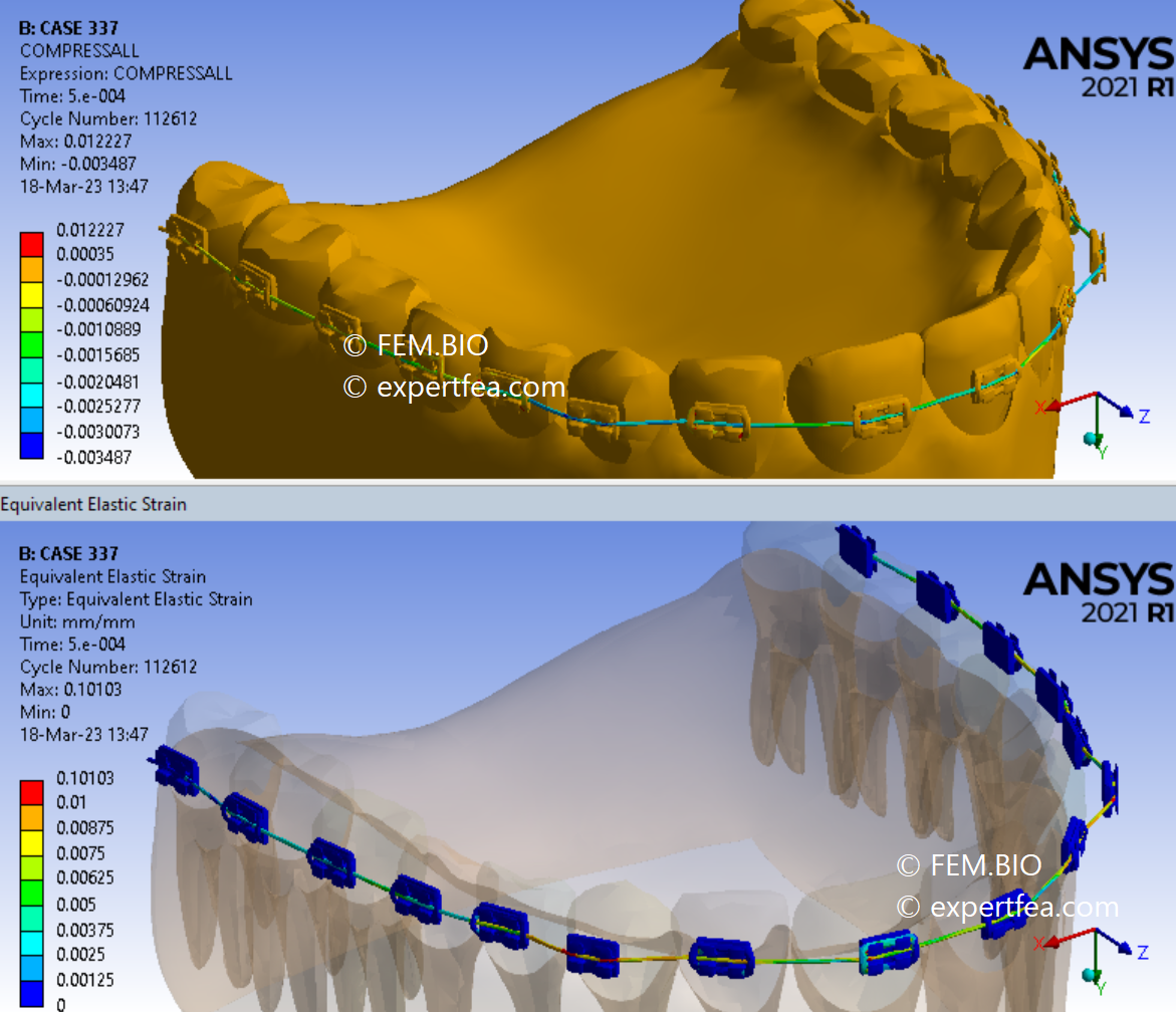ANSYS Workbench 2021 R1 WBPZ archive and 3D model for dental braces ...